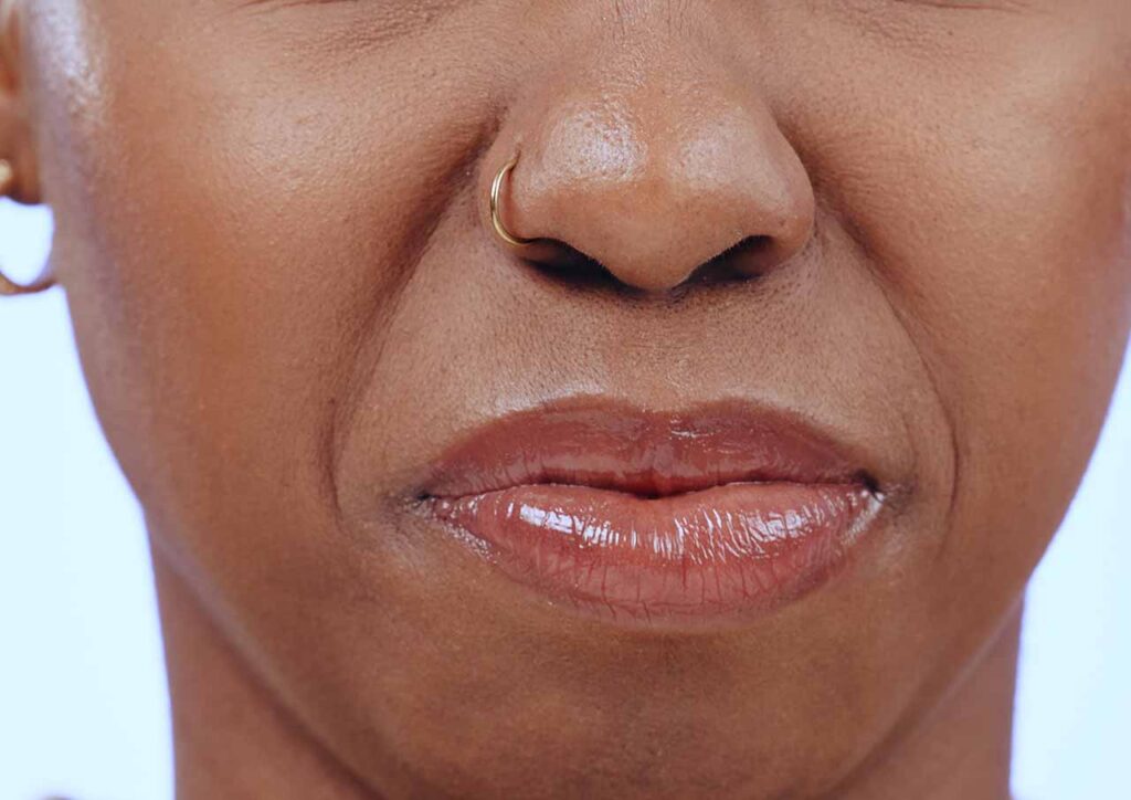 Nasolabial Folds (Smile Lines) - Monaz Clinic London