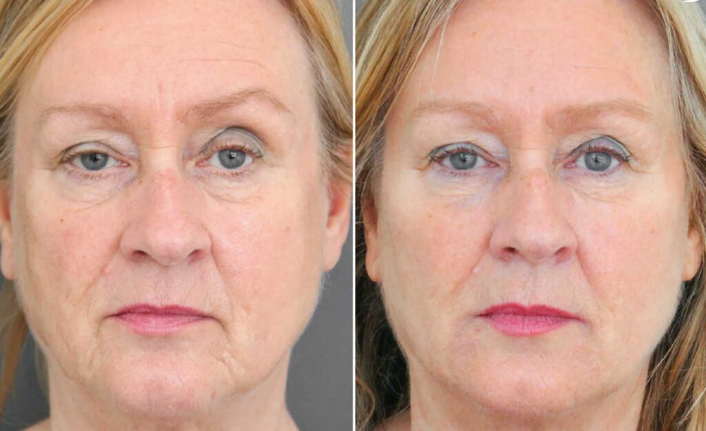 Chin Dimples and Pebbling - Monaz Clinic London