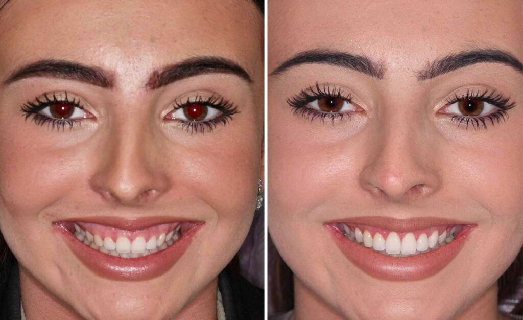 Gummy Smile Correction - Monaz Clinic London
